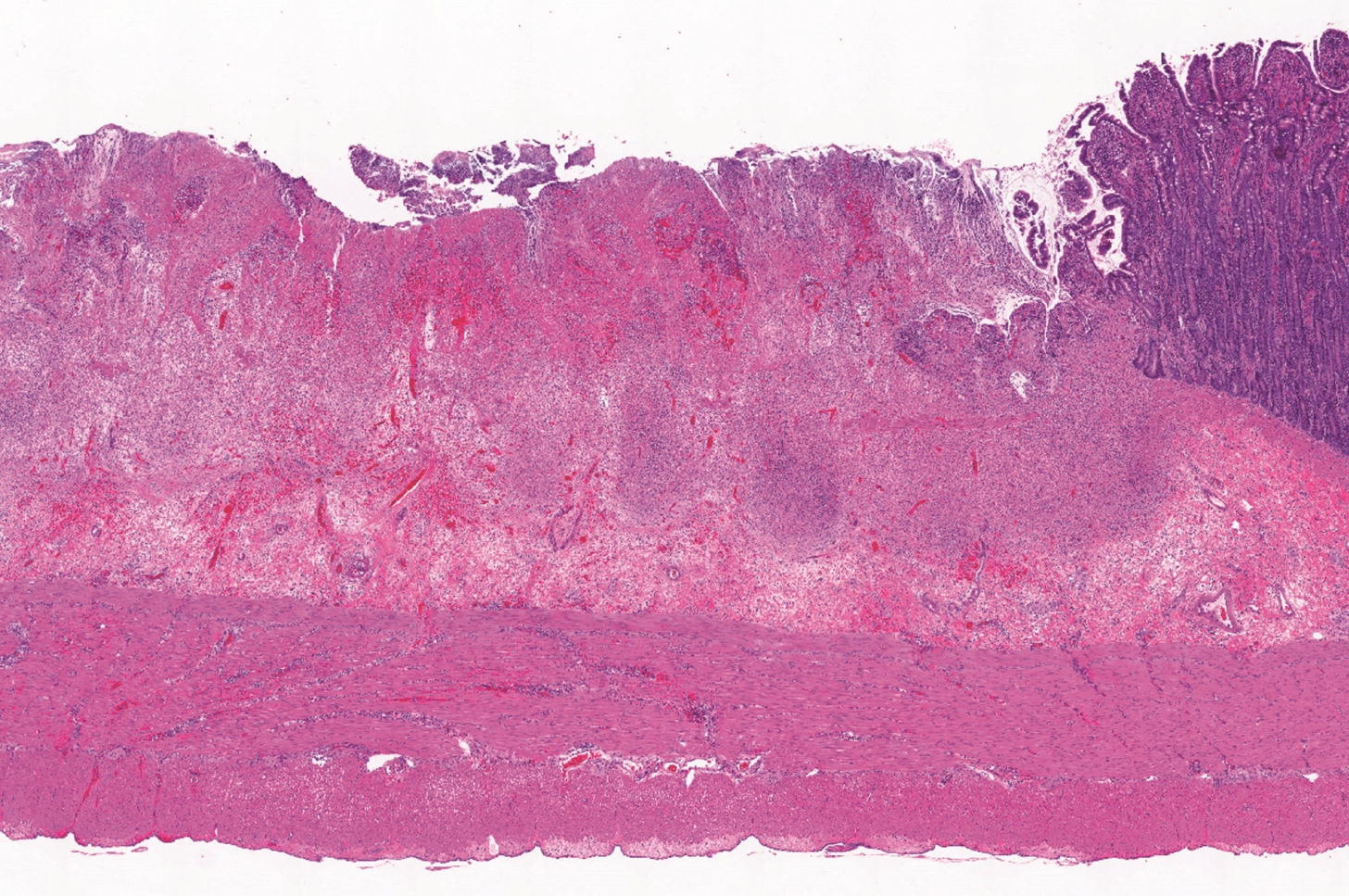 Management of acute upper gastrointestinal bleeding - The ...
