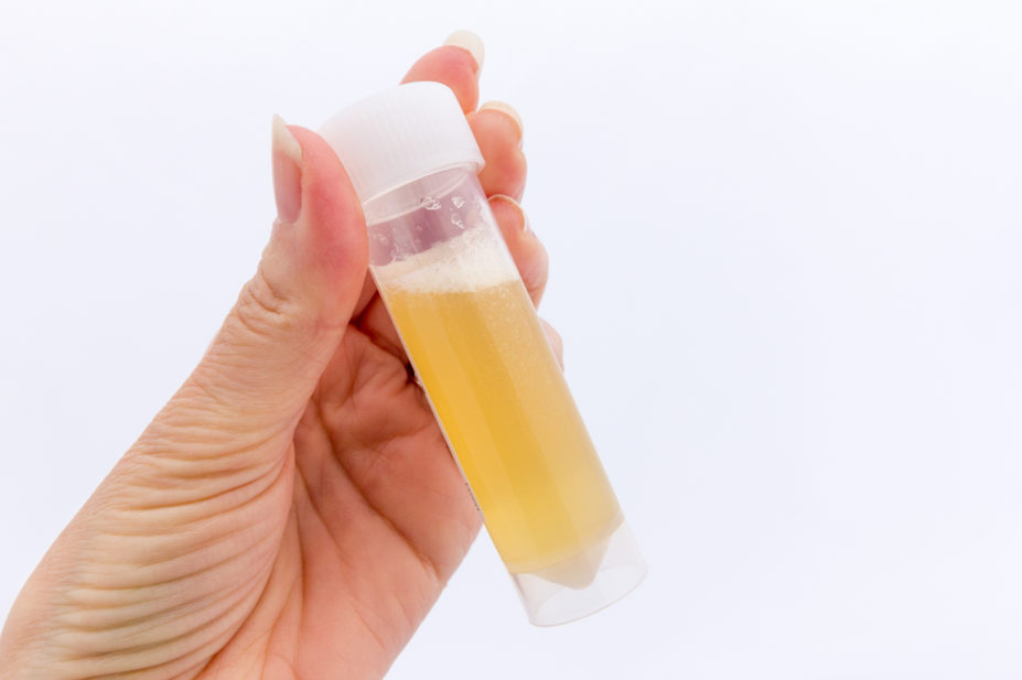 Nephrotic syndrome in adults: symptoms and management - The ...