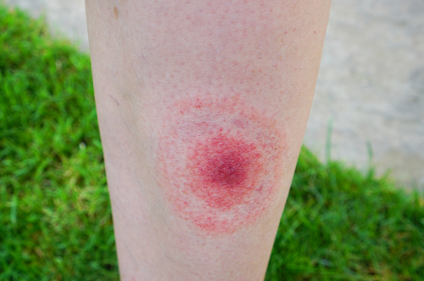 NICE publishes draft guidance on Lyme disease - The Pharmaceutical Journal