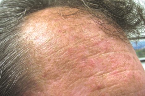 Actinic keratosis gel linked with allergic reactions and shingles - The ...