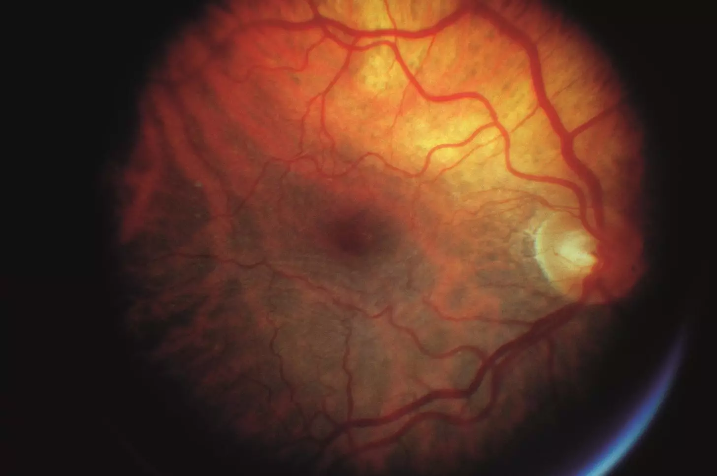Peptide-like drug eye drops show promise for retinal conditions - The ...