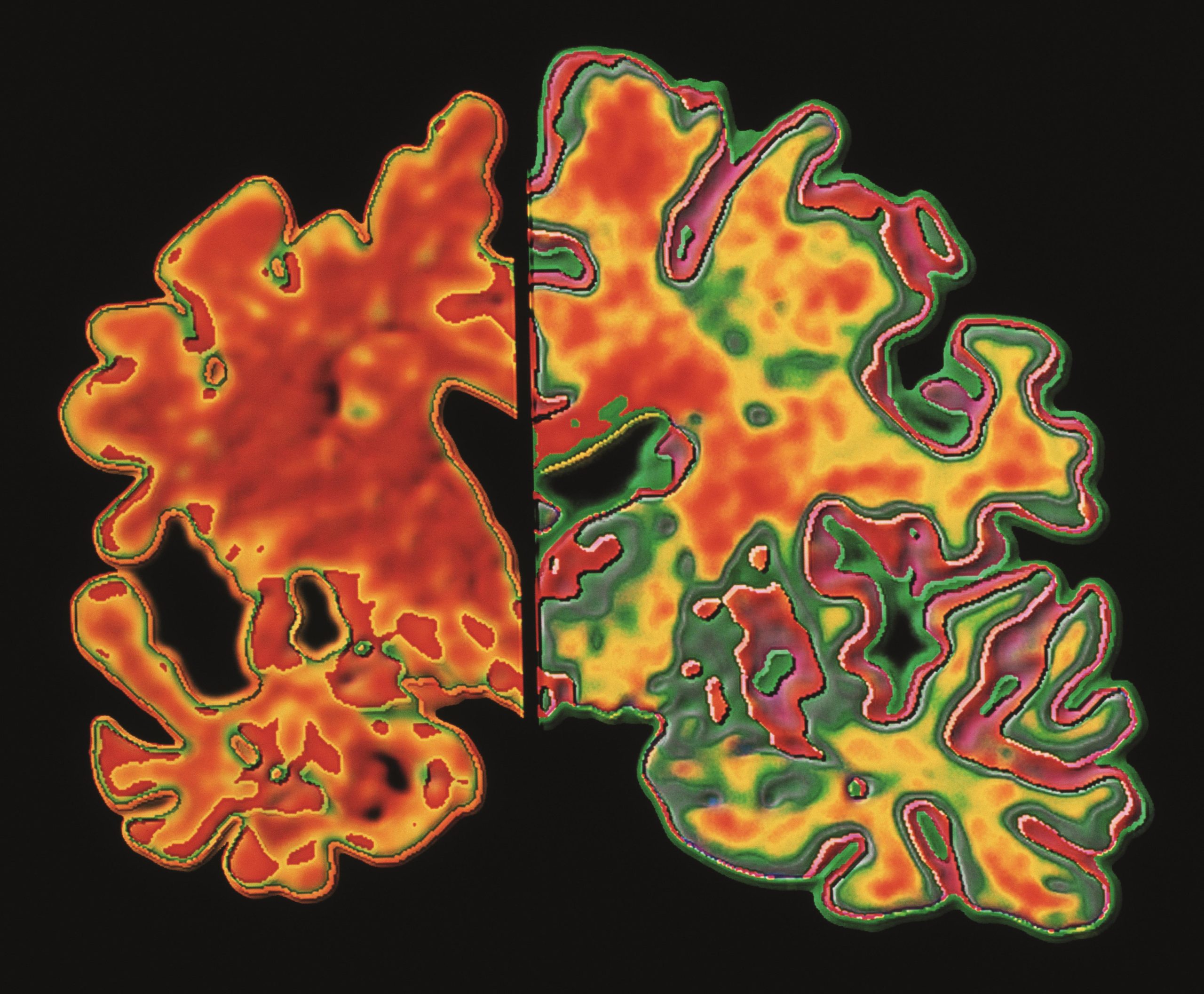 Data suggest that new Alzheimer’s drug solanezumab has disease ...