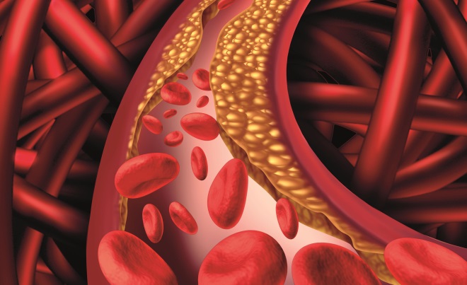 Gaps between clinical guidelines and practice for lipid management in ...