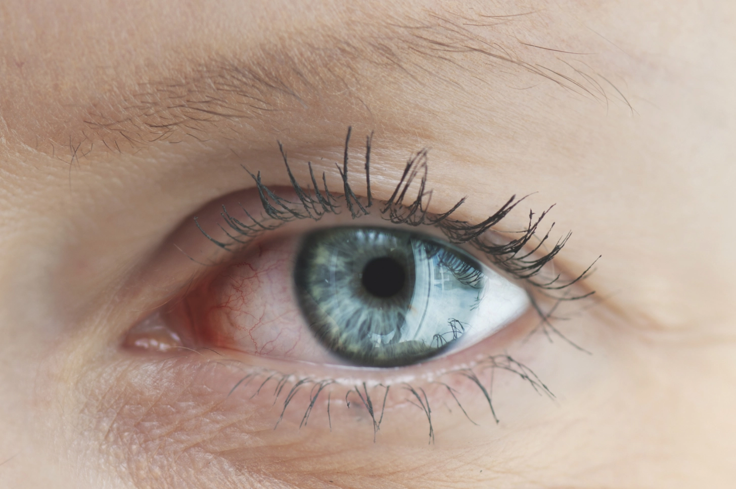 Pharmacy Technician's Guide - Dry eye disease: pathophysiology and risk ...