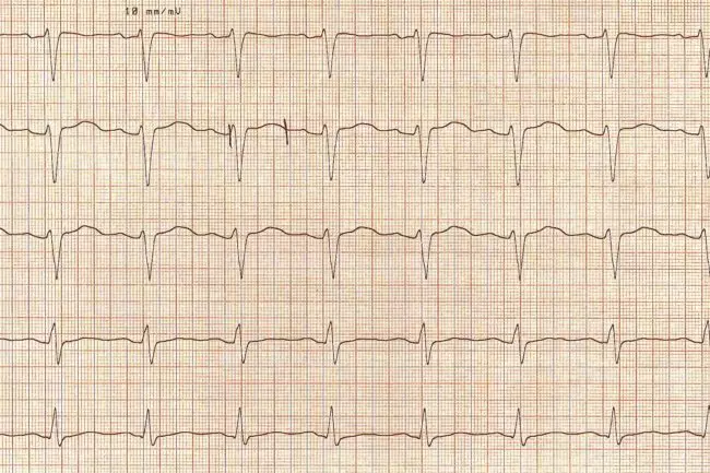 Long QT syndrome - The Pharmaceutical Journal