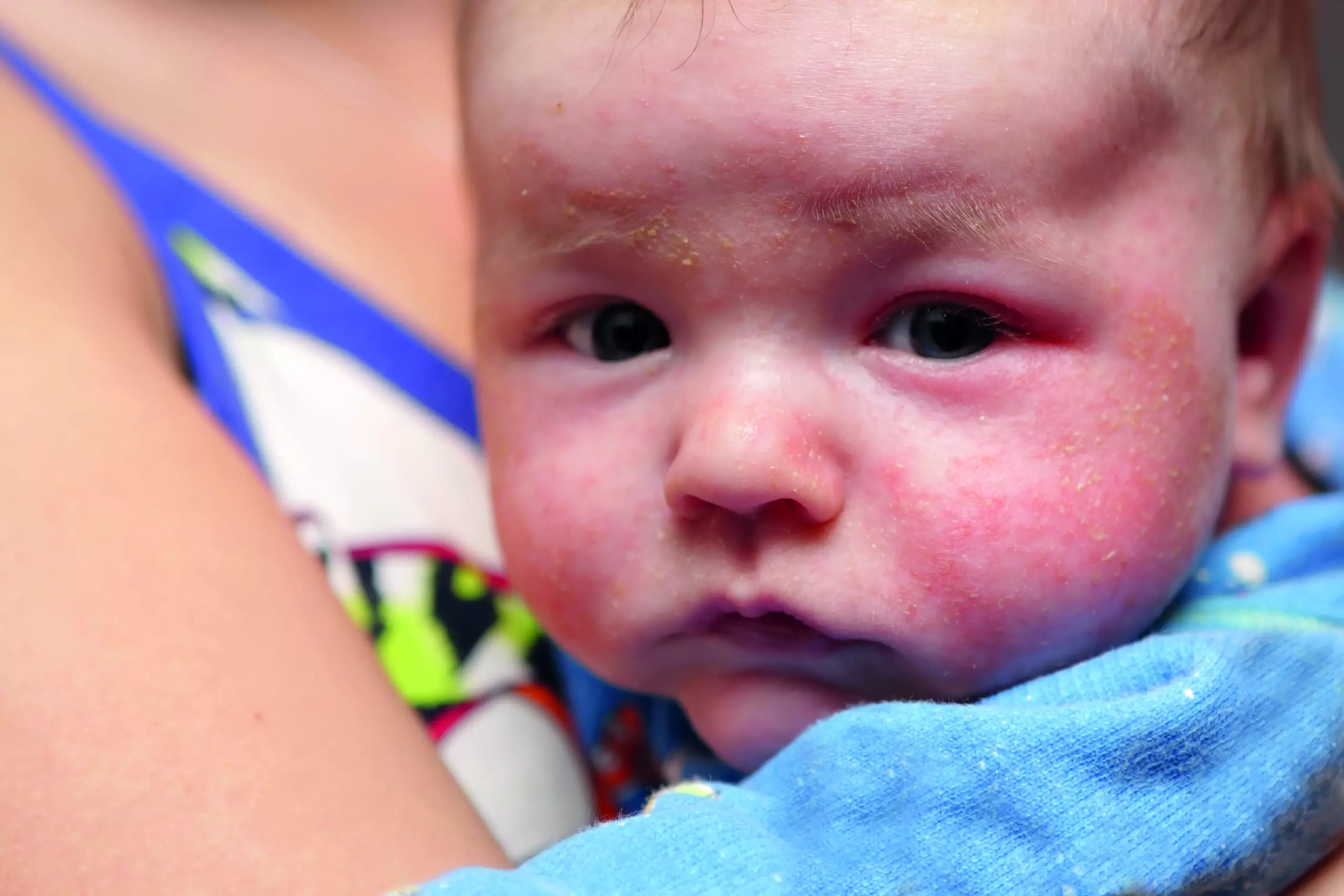 Antibiotics not always necessary for paediatric atopic dermatitis - The ...