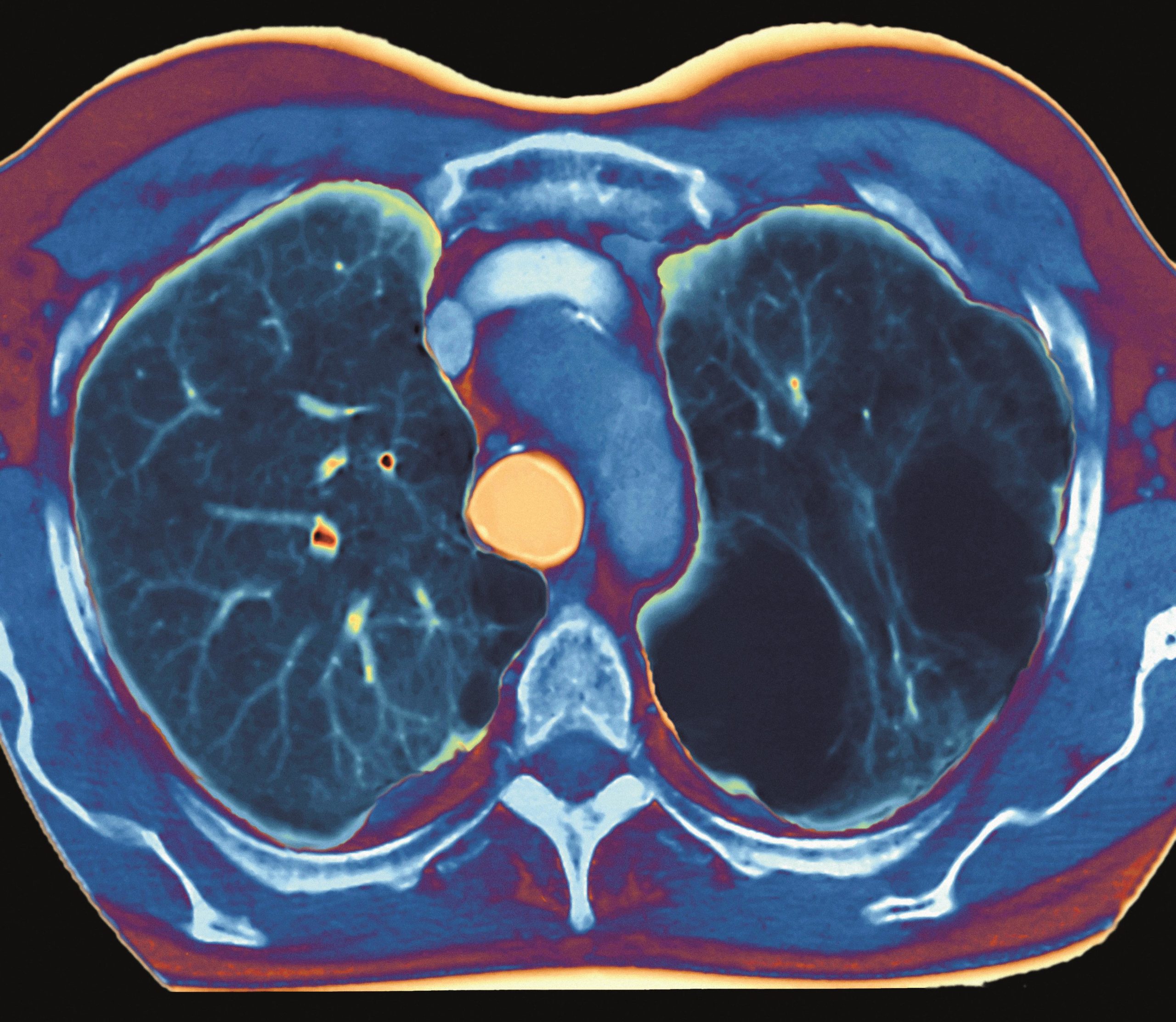 Pharmacy support for COPD patients improves medicine-taking behaviour ...