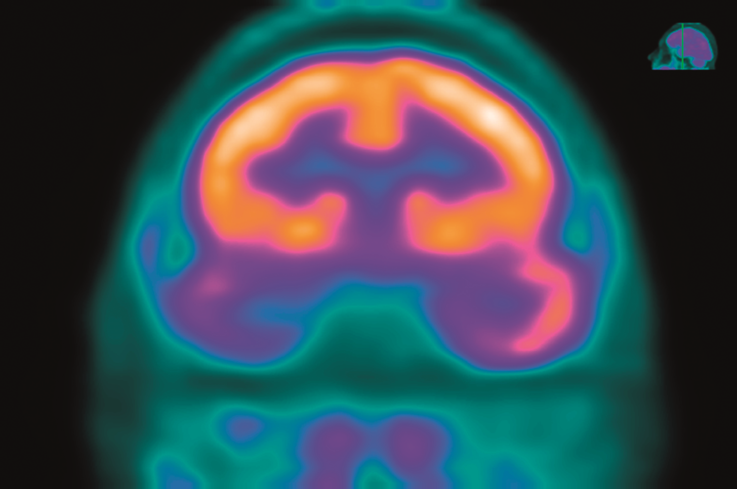 Refractory epilepsy: management in tertiary care - The Pharmaceutical ...