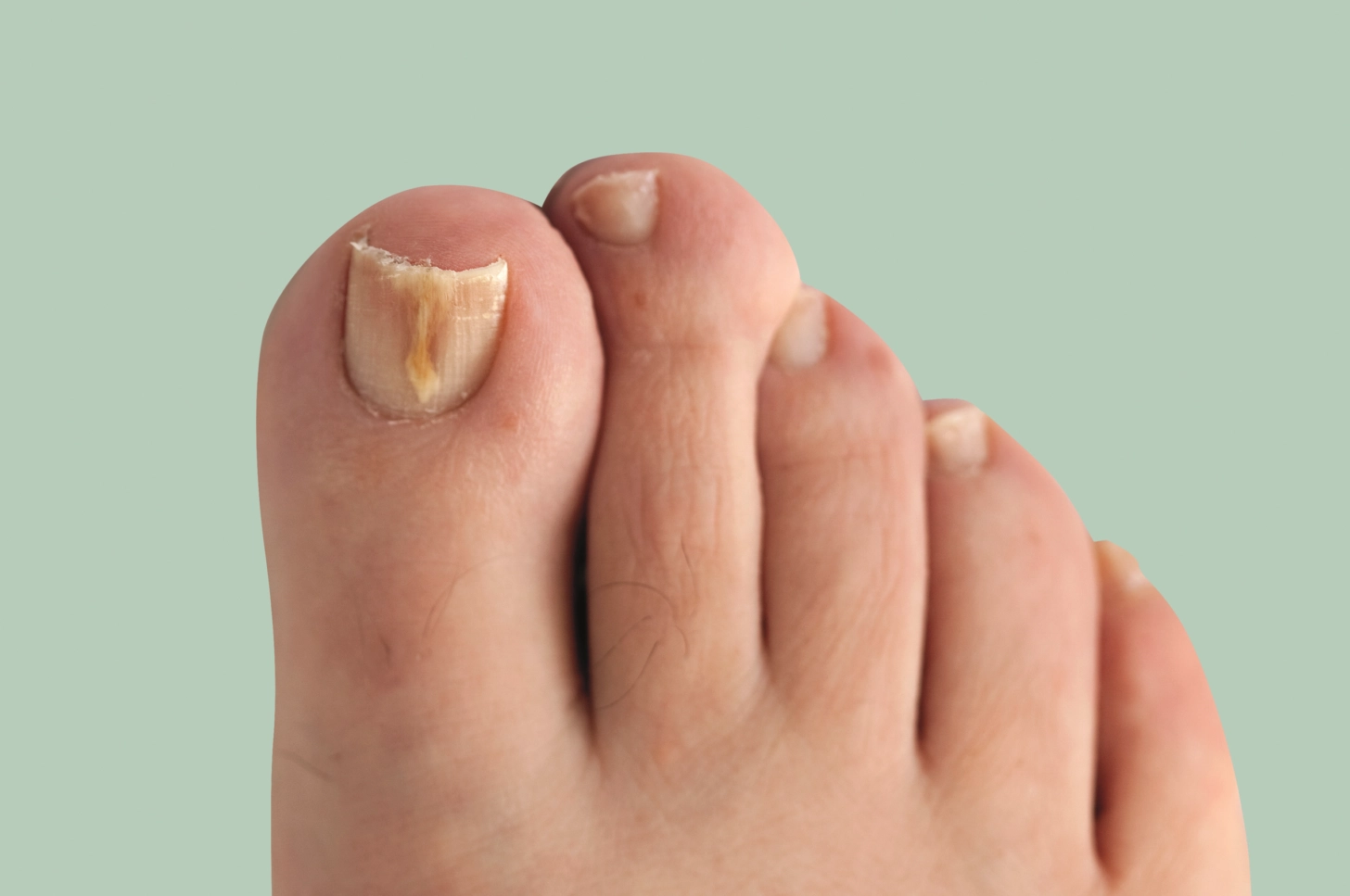 How to treat fungal nail effectively - The Pharmaceutical Journal