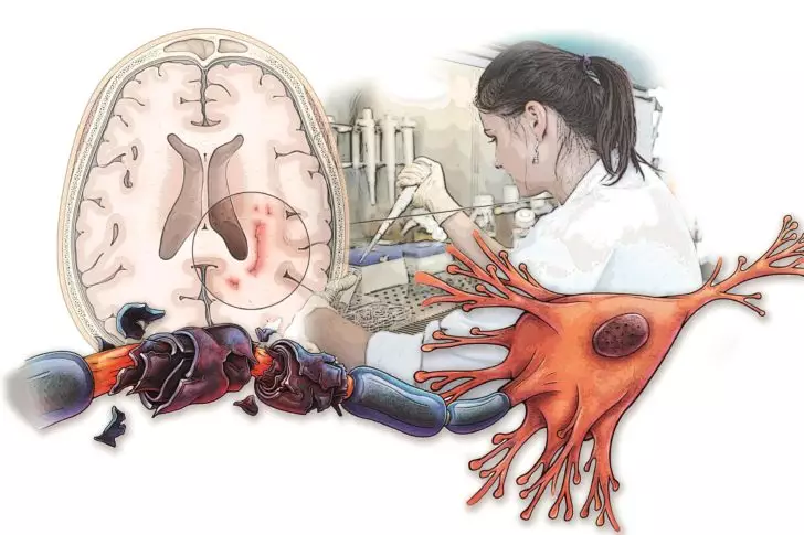 Search for progressive multiple sclerosis treatment is gathering ...