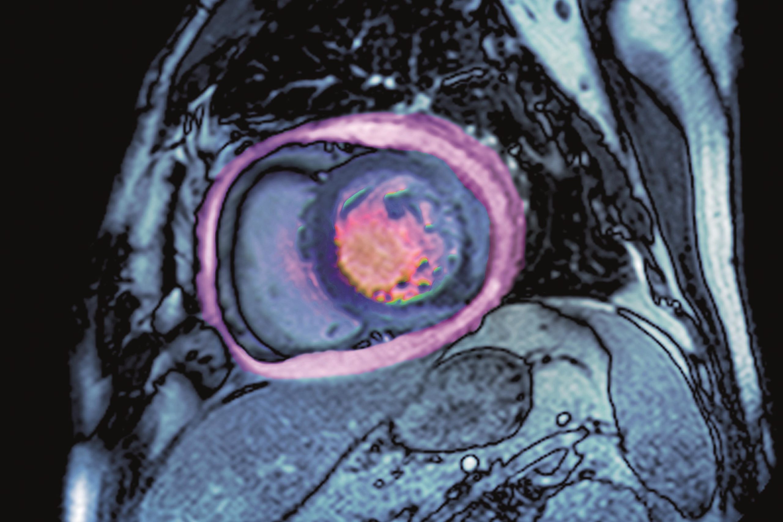 New heart failure drug extends survival by up to two years - The ...