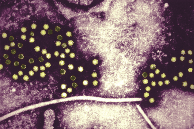 Hepatitis E virus infection: signs, symptoms and management - The ...