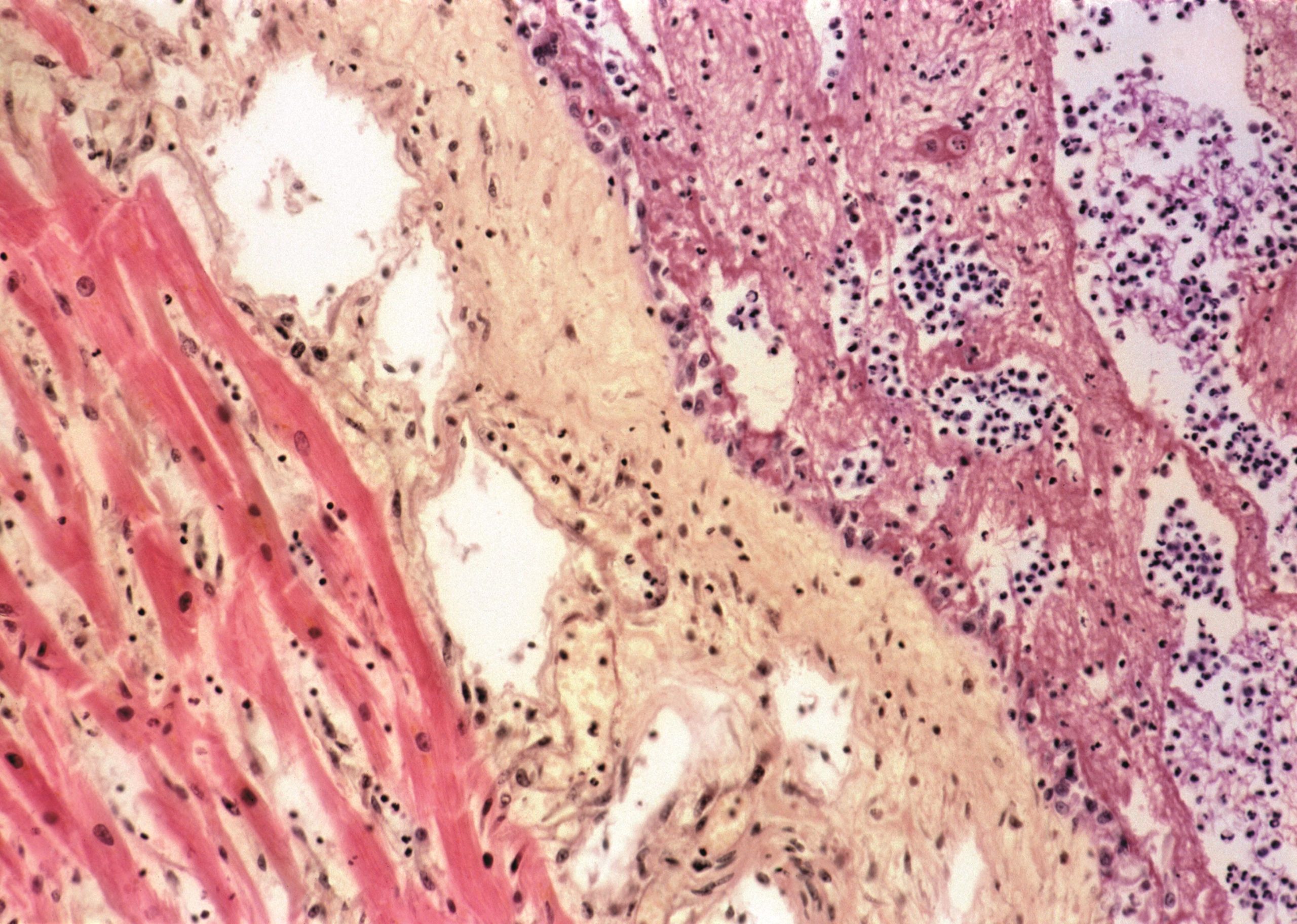 Study reveals inflammatory process linking diabetes with heart disease ...