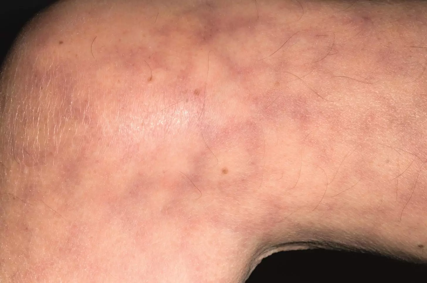 Antiphospholipid syndrome: pathophysiology, diagnosis and treatment ...