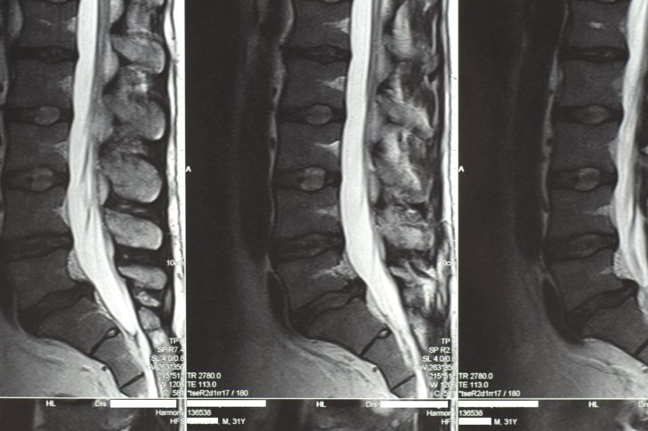 Oral steroids provide a modest boost to function for patients with ...