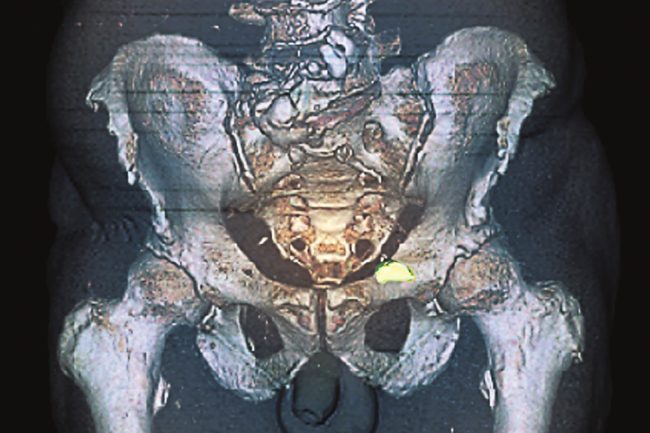 Prostate cancer: treatment options - The Pharmaceutical Journal