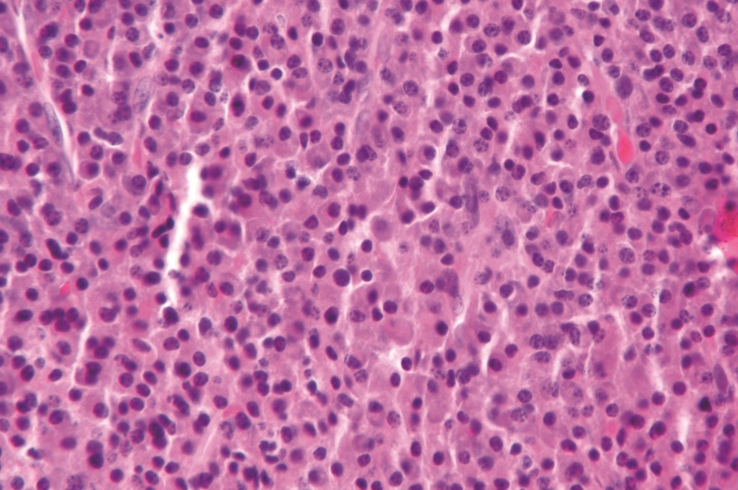 Carfilzomib gives survival benefits to patients with relapsed multiple ...