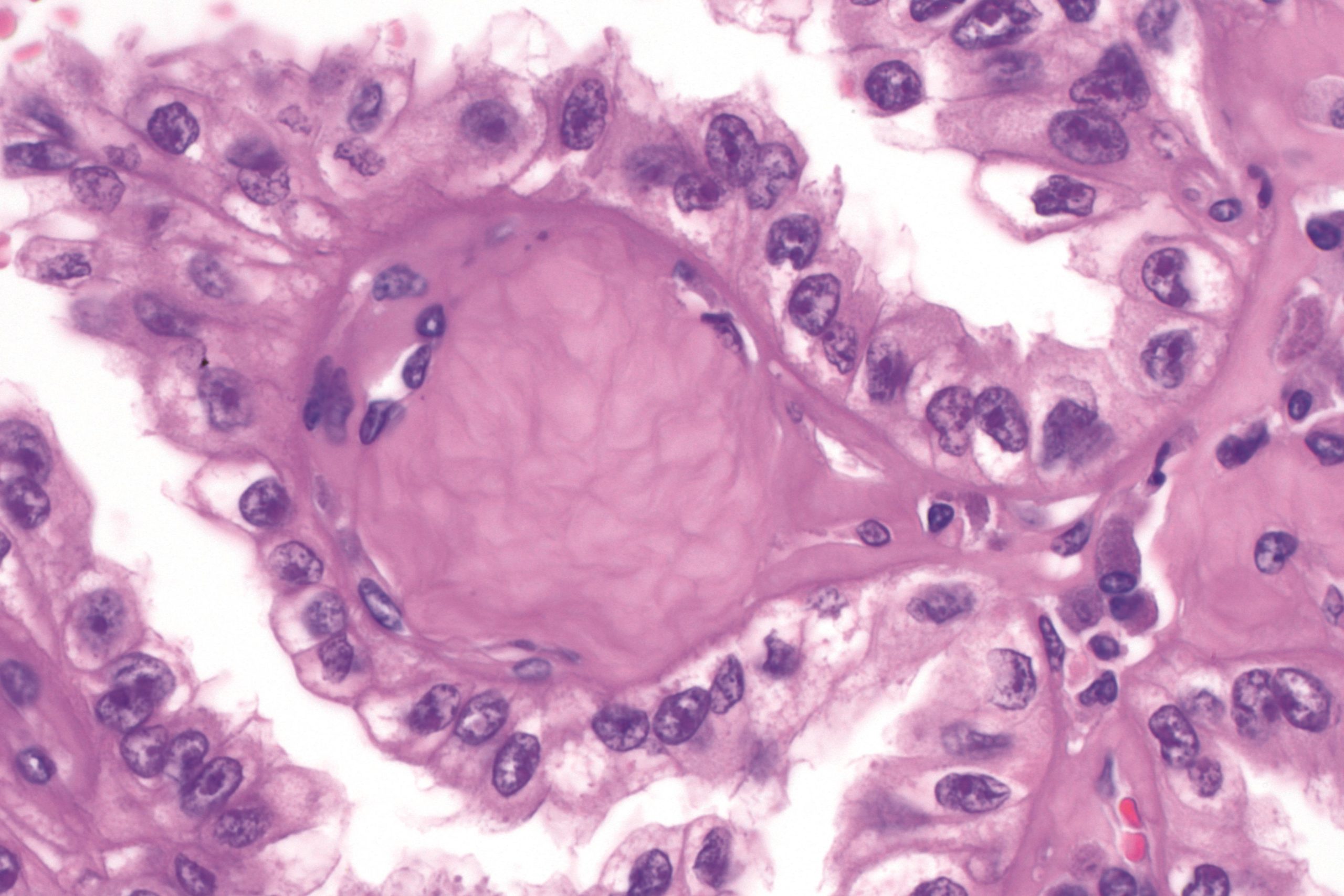 EMA recommends two new kidney cancer drugs for approval - The ...