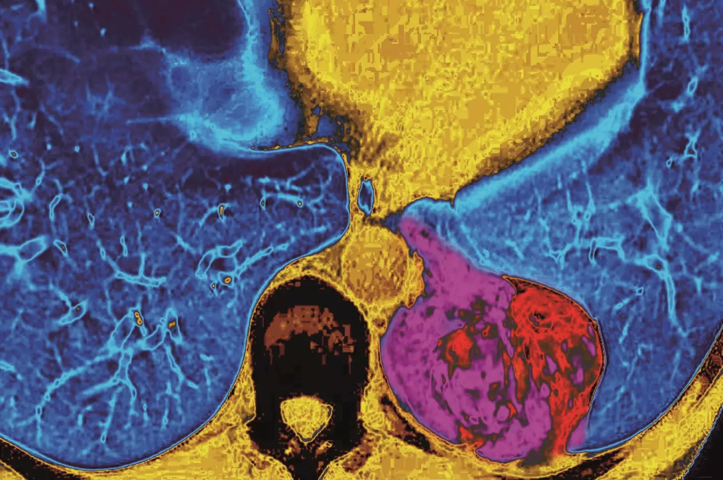 Alectinib approved by FDA for ALK-positive lung cancer - The ...