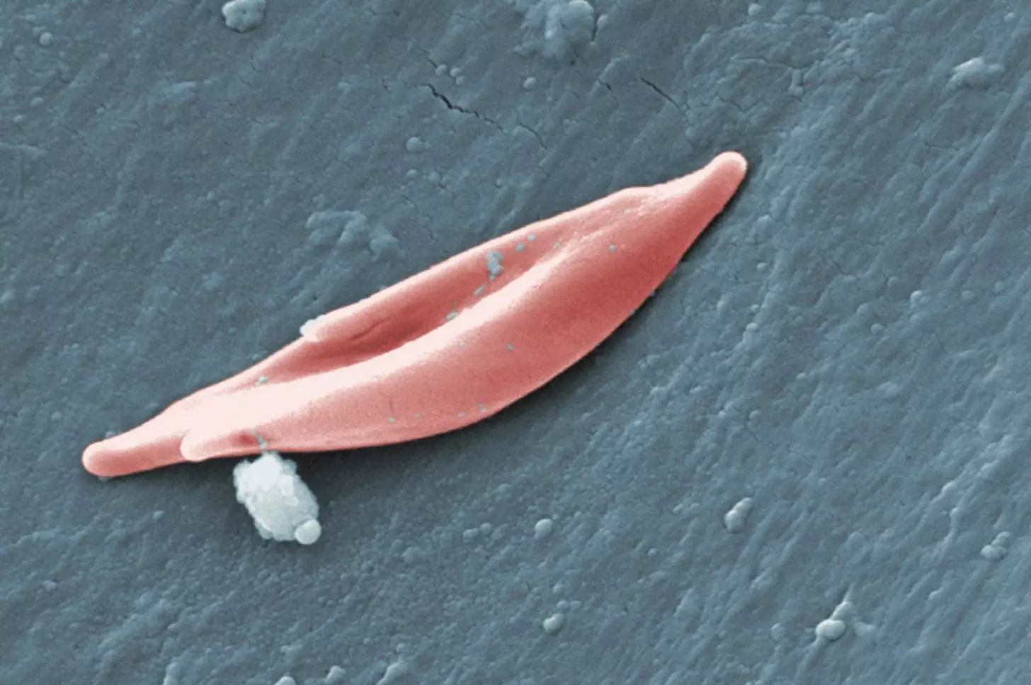 Sickle cell disease: symptoms, complications and management - The ...