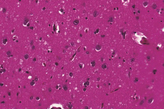 Brains of CJD victims show signs of Alzheimer’s pathology - The ...