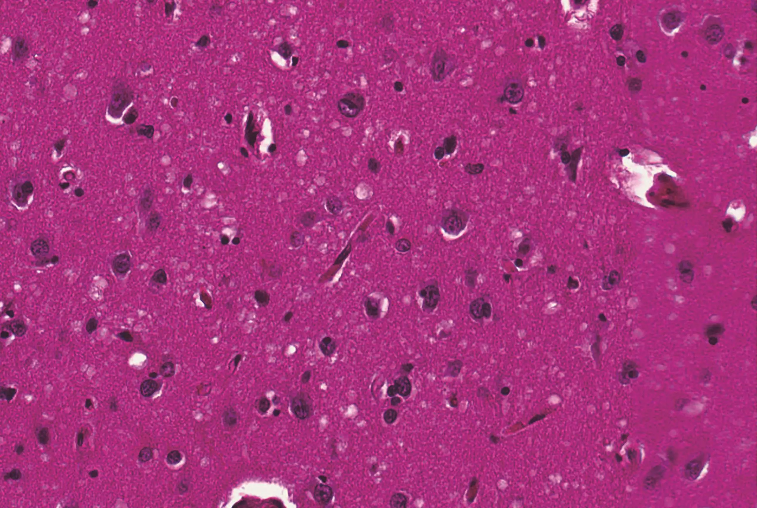 Brains of CJD victims show signs of Alzheimer’s pathology - The ...