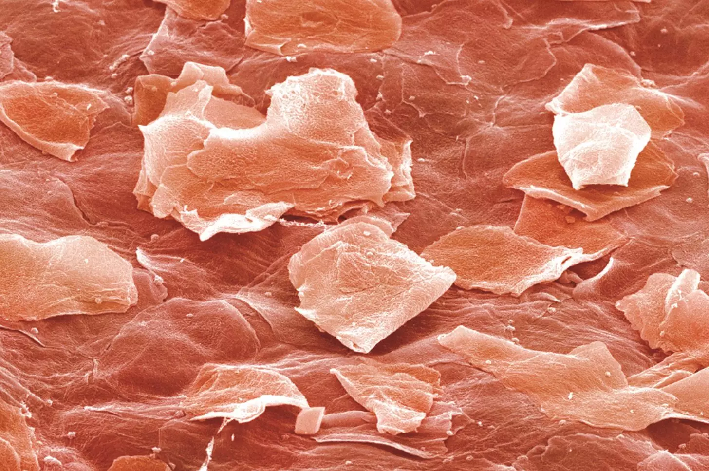 First drug for rare sun disease recommended for approval in Europe ...