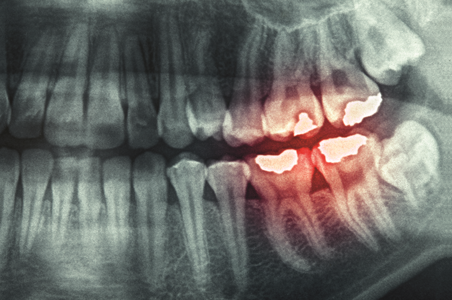 NSAIDs preferred choice for acute dental pain, review finds - The ...