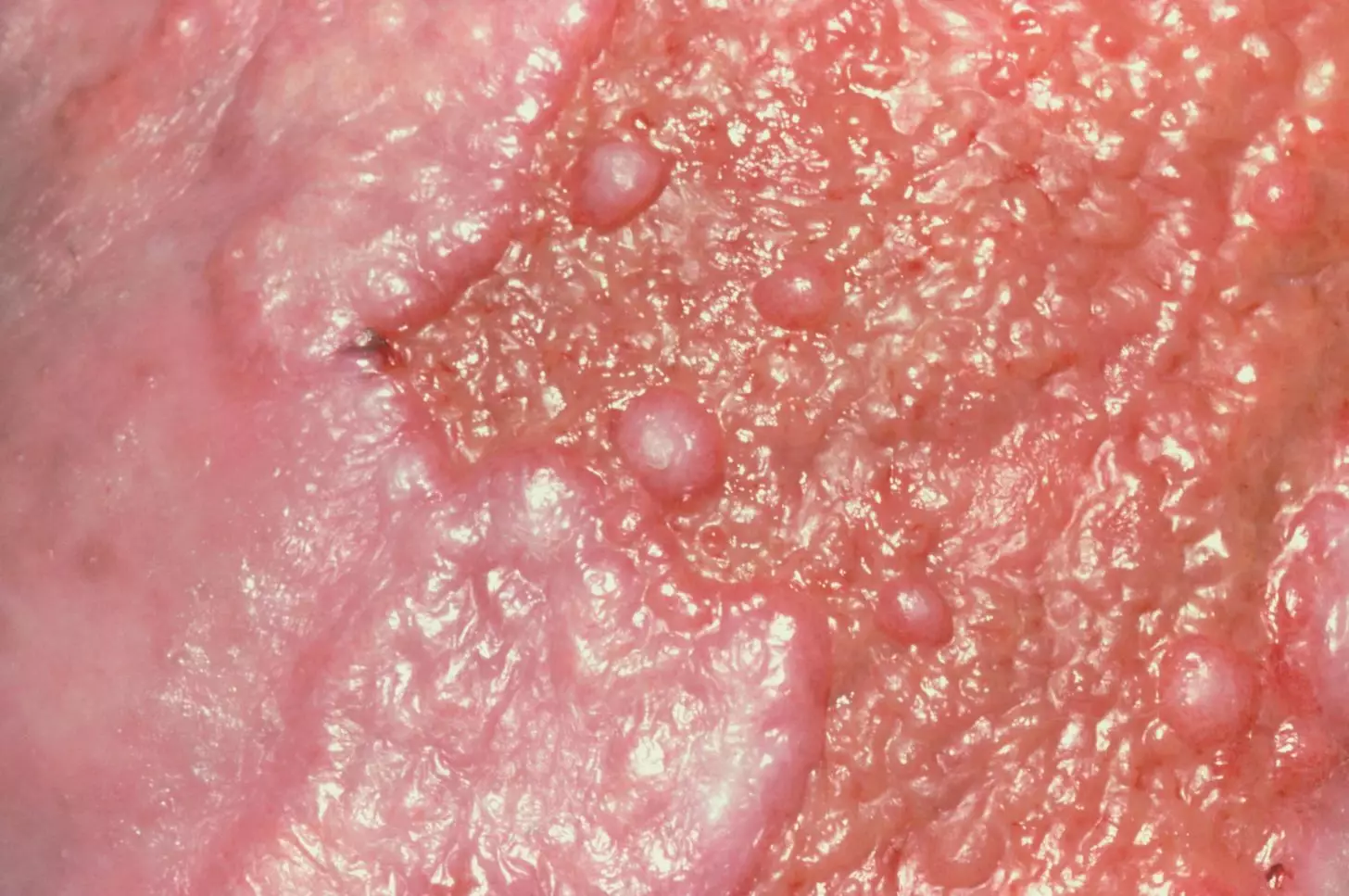 Burns: assessment and treatment - The Pharmaceutical Journal