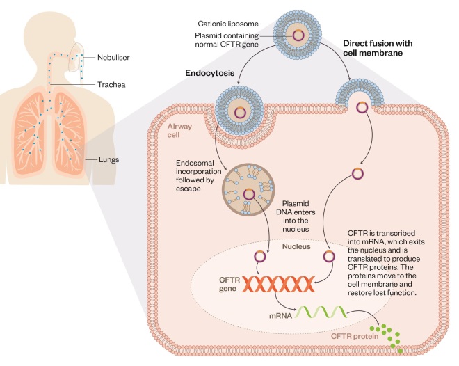 Cystic Fibrosis Gene Lung Targeted CRISPR Therapy Offers Hope For Cystic Fibrosis Gene Lung Targeted CRISPR Therapy Offers Hope For