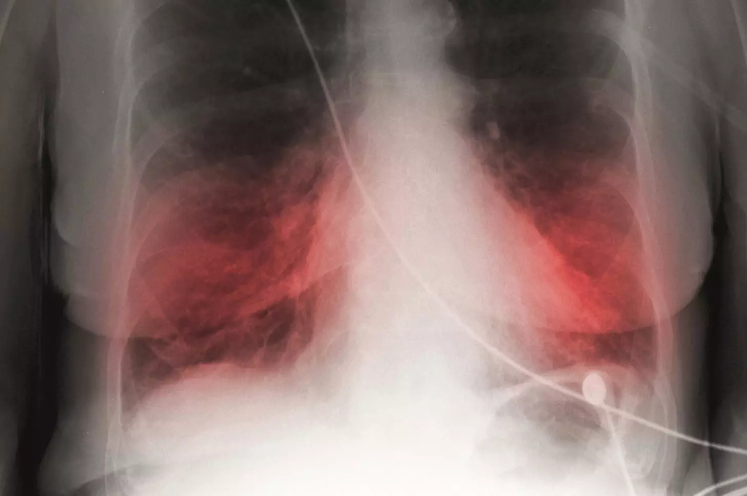 COPD patients who use opioids at risk from respiratory complications ...