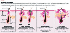 Do long-term antibiotics for acne fuel antimicrobial resistance? - The ...
