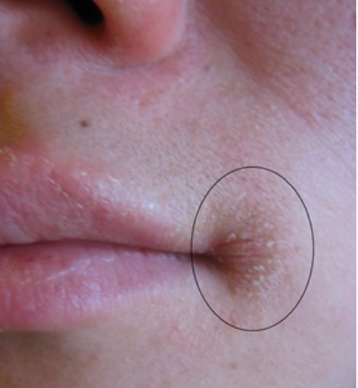 Angular cheilitis - The Pharmaceutical Journal