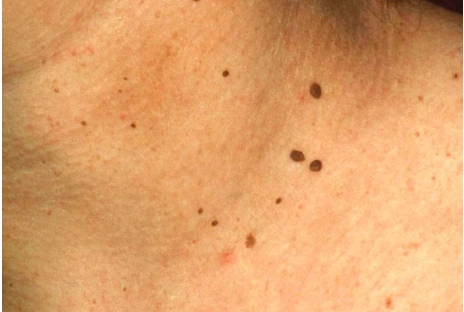 Advice on how to treat skin tags - The Pharmaceutical Journal