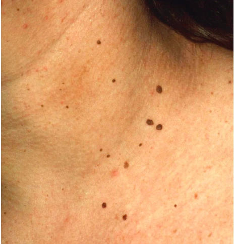 Advice on how to treat skin tags - The Pharmaceutical Journal