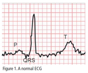 Arrhythmias — overview of the condition - The Pharmaceutical Journal