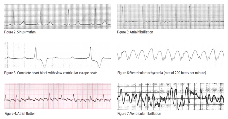 Arrhythmias — overview of the condition - The Pharmaceutical Journal
