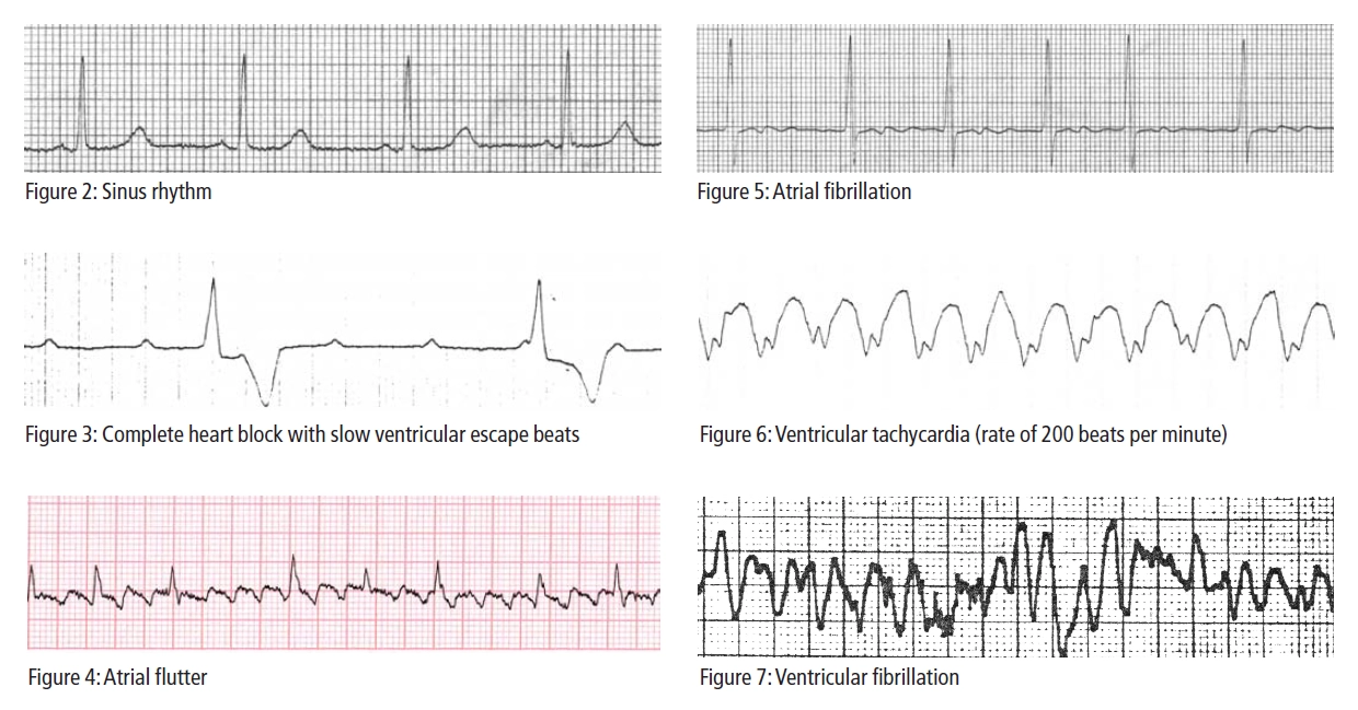 Arrhythmias — overview of the condition - The Pharmaceutical Journal