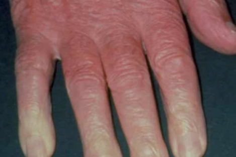Managing Raynaud’s phenomenon - The Pharmaceutical Journal