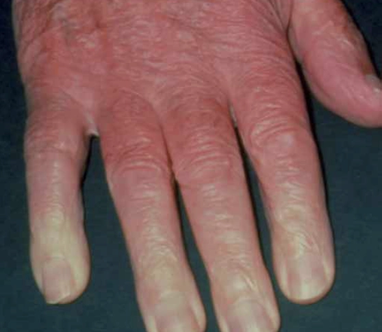 Managing Raynaud’s phenomenon - The Pharmaceutical Journal