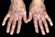 Epidermolysis bullosa: recognition and management - The Pharmaceutical ...