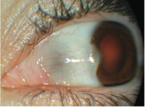 Ocular conditions from A to Z (ii) - The Pharmaceutical Journal