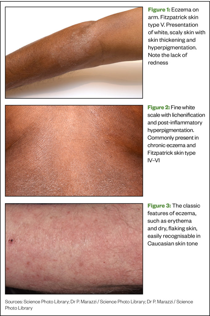 Recognising common skin conditions in people of colour - The ...