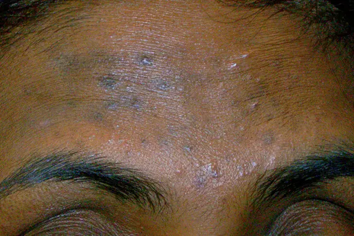 Recognising common skin conditions in people of colour - The ...