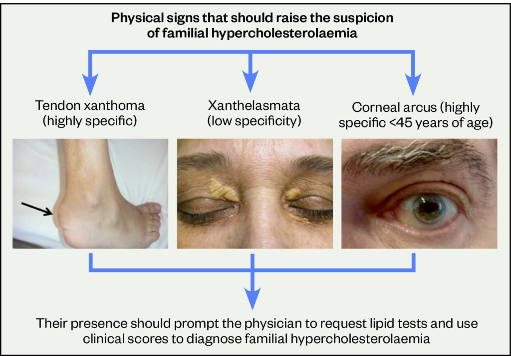 Familial hypercholesterolaemia: identification and management - The ...