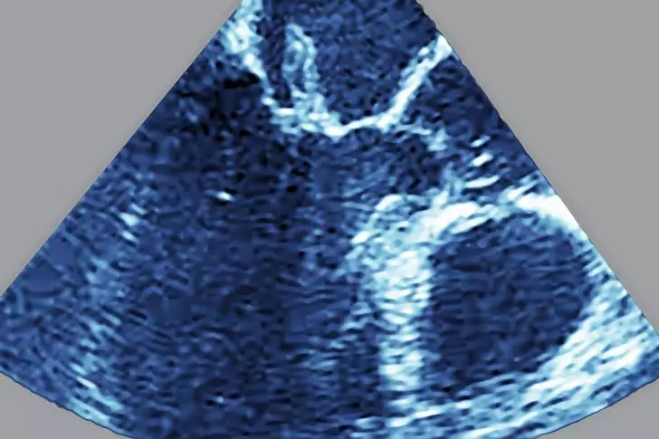 Infective endocarditis: diagnosis, treatment and prevention - The ...