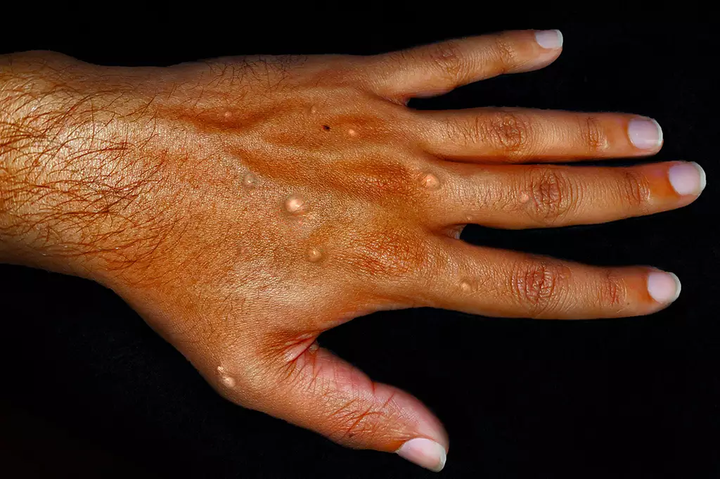 Antiviral treatment now available on NHS for patients with severe or ...