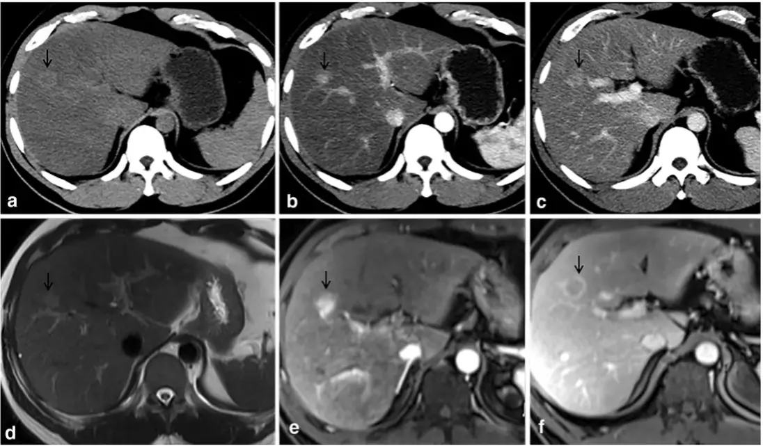Liver cancer: screening, diagnosis and management - The Pharmaceutical ...