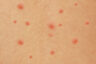 Chickenpox: symptoms, treatment and potential complications - The ...