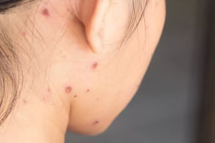 Chickenpox: symptoms, treatment and potential complications - The ...